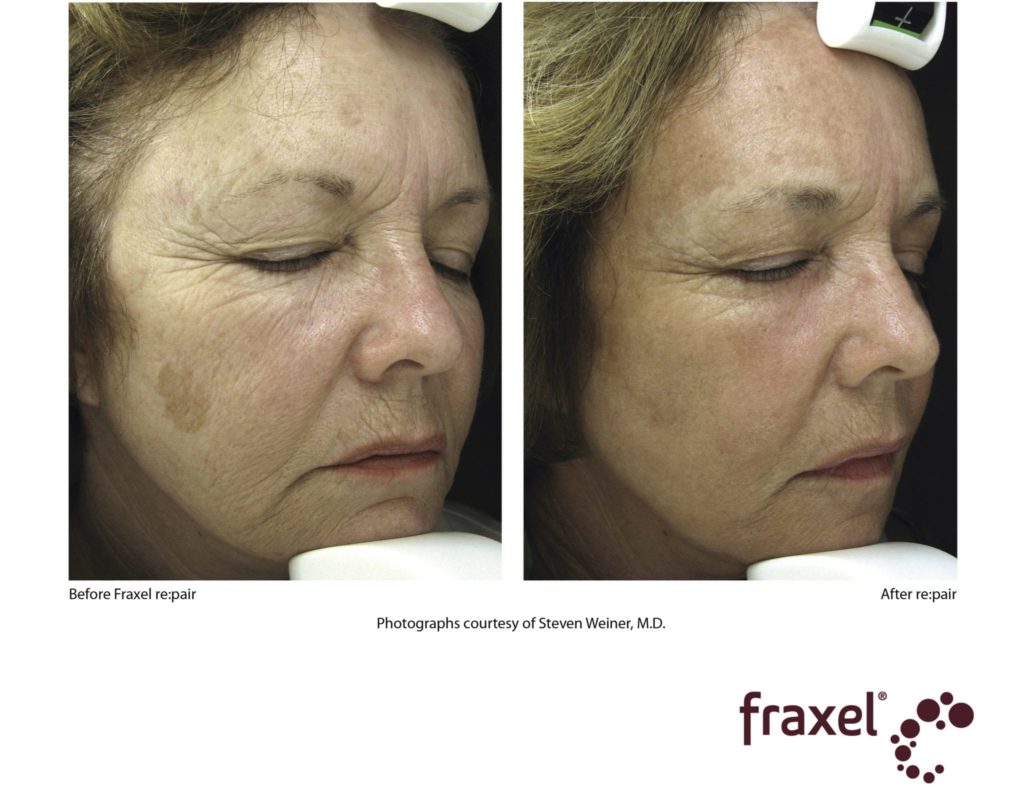 Laser Skin Resurfacing Braselton | Fraxel Laser Loganville, GA