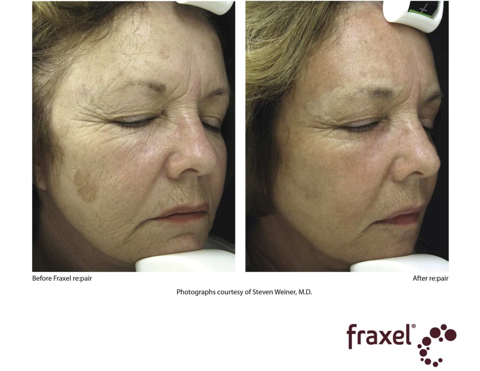 Laser Skin Resurfacing Braselton | Fraxel Laser Loganville, GA